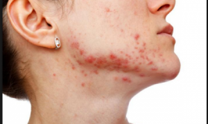 Akrodermatitis Enteropatika nedir? Belirtileri ve Tedavisi - Sağlıklı ...